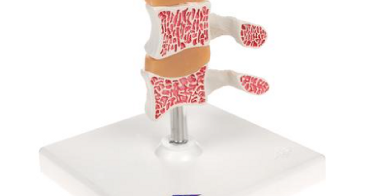 Osteoporosis model 2 vertebrae